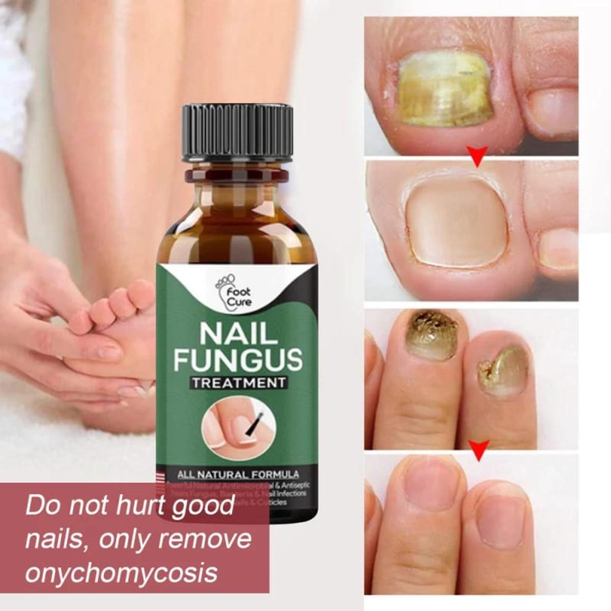 Original Nail Fungus Treatment Stop Fungal Growth Effective Fingernail ...